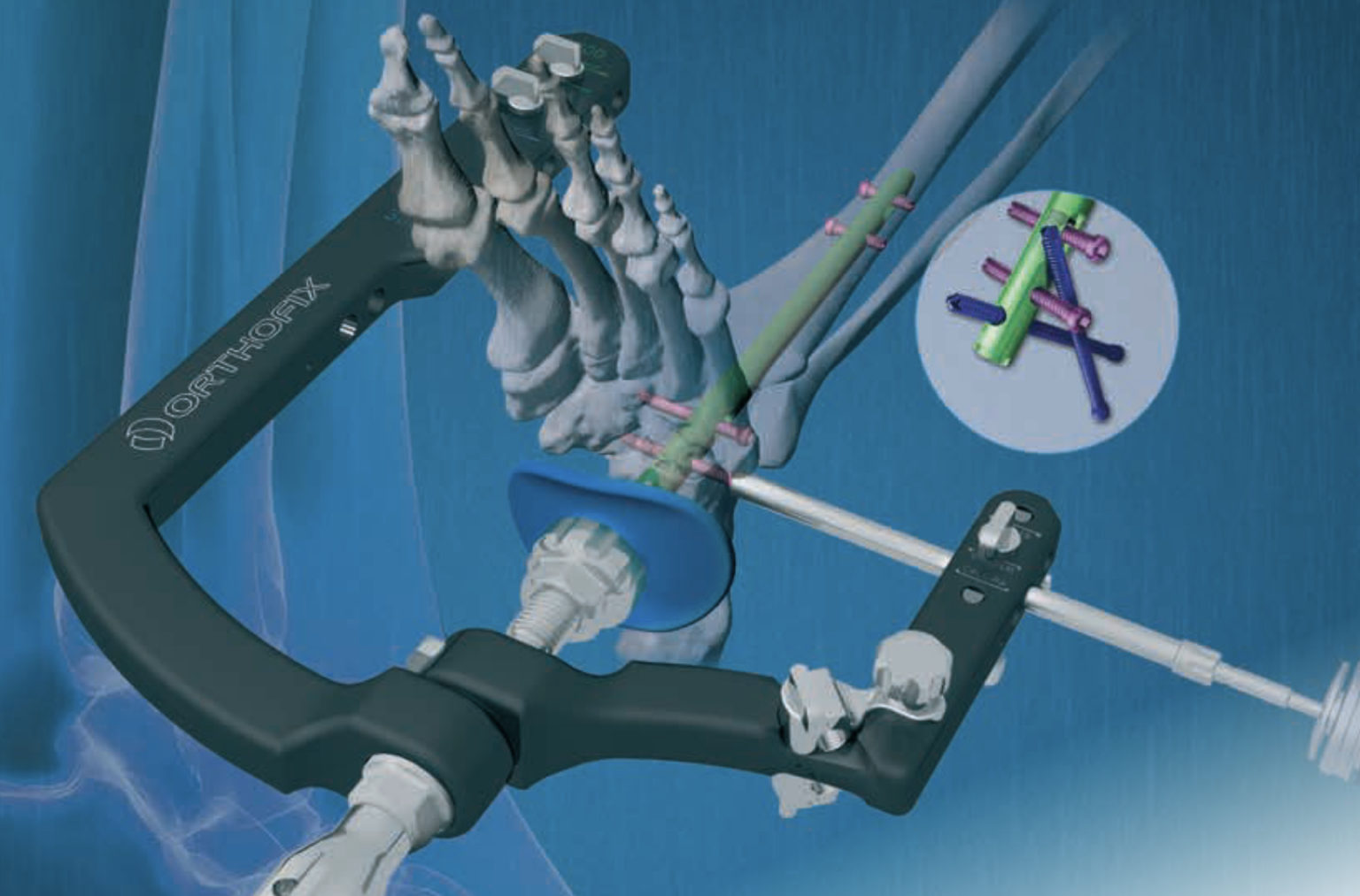 FitboneAHN – www.orthocycle.org